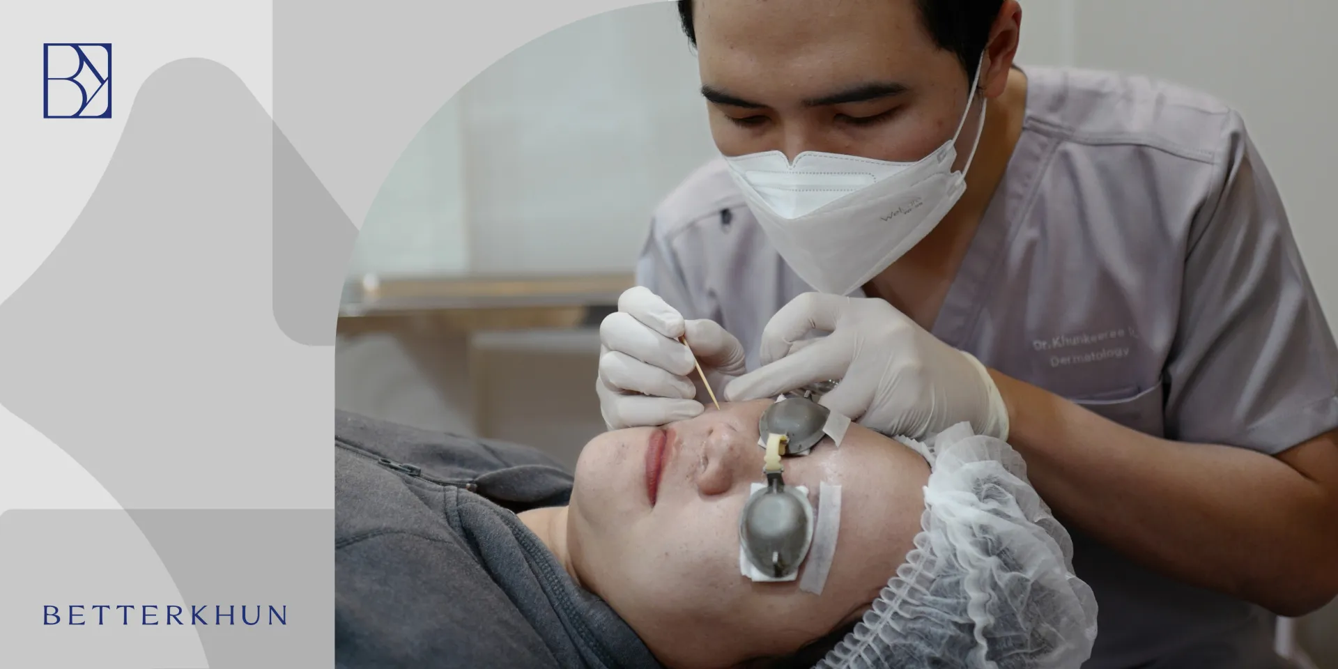 Ice Pick Scars – Causes, Treatments, and How to Finally Heal Acne Scars